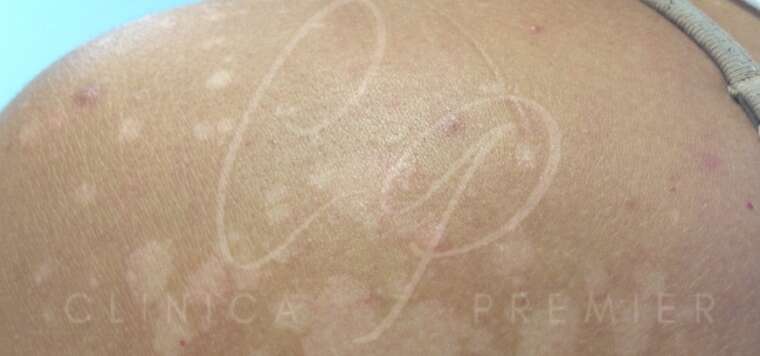 Pitiriasis versicolor: causas, síntomas y tratamiento – Dermatólogo en ...